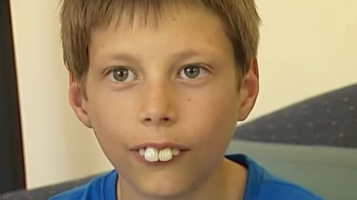 Prezývali ho Králičí chlapec: Po rokoch trápenia sa vďaka operácii ...