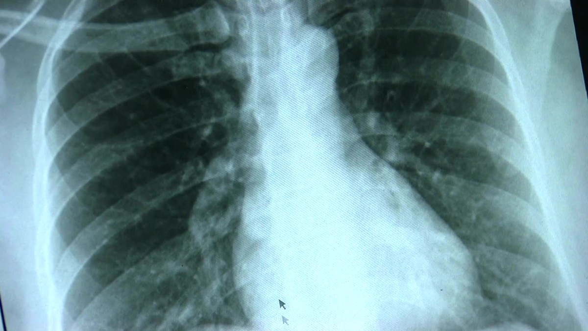 7 skorých príznakov rakoviny pľúc, o ktorých by ste mali vedieť