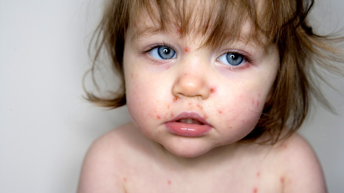 Ovčie kiahne v dospelosti môžu spôsobiť výrazné problémy